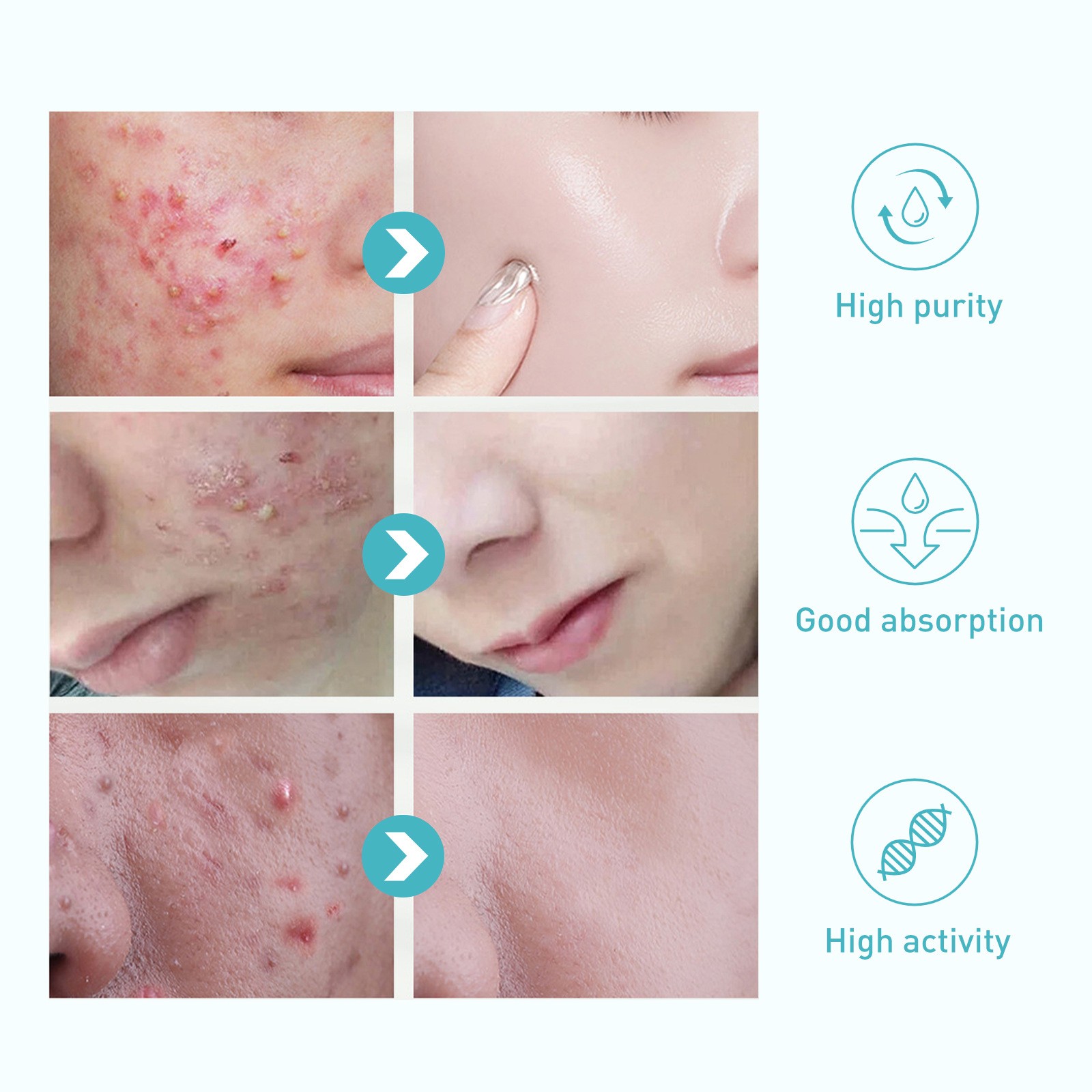 Clear Out Stock! Awwp Green 1X Acne Repair Gel Acnes Repairs Gel Fades ... Clear Out Stock! Awwp Green 1X Acne Repair Gel Acnes Repairs Gel Fades ...